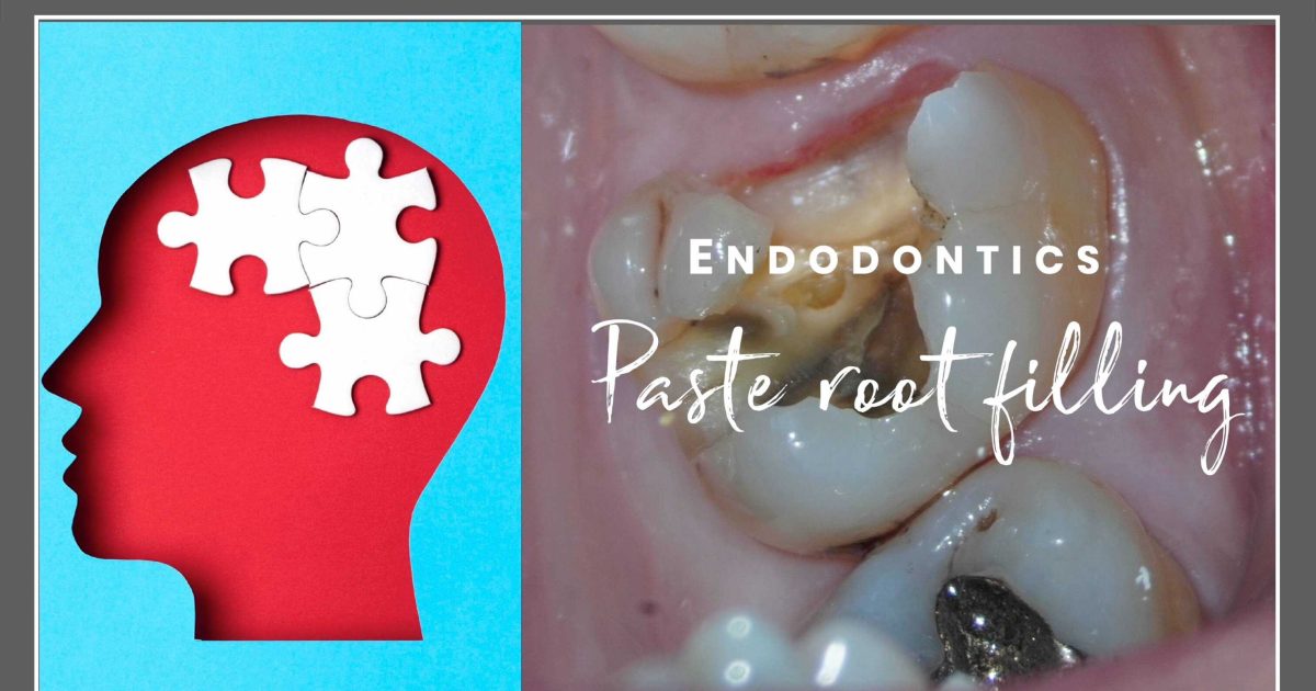 Clinical case: Paste root filling | Contemporary Endodontics