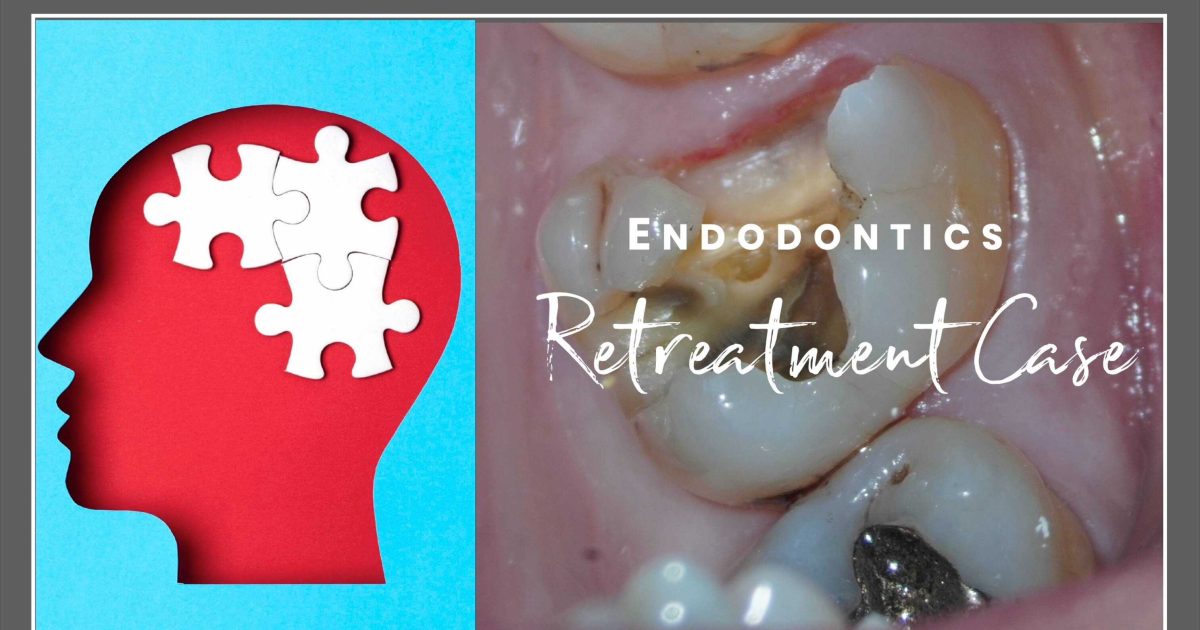 Clinical case: Lower anteriors, fractured instrument and missed anatomy ...