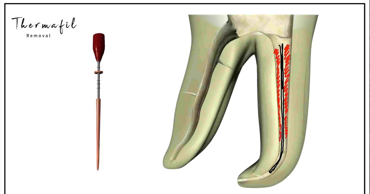 Thermafil removal - theory | Contemporary Endodontics